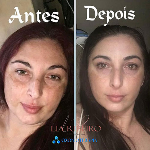 O Jato de Plasma e seus benefícios